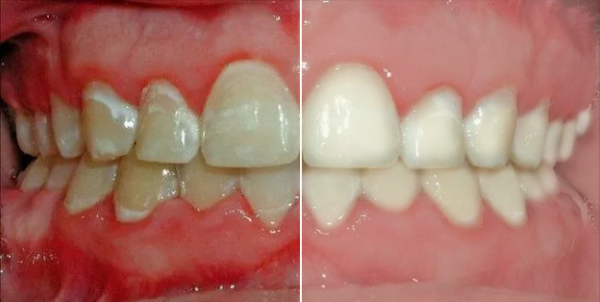 Spotted Teeth? What Not Brushing With Braces Can Leave Behind -Canby, OR