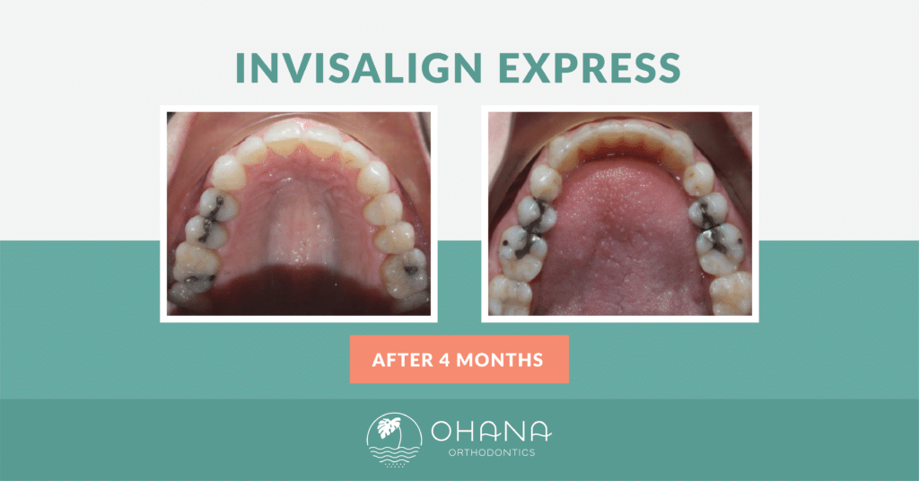 Before and After Photos Show Invisalign Helps Your Smile - Ohana ...