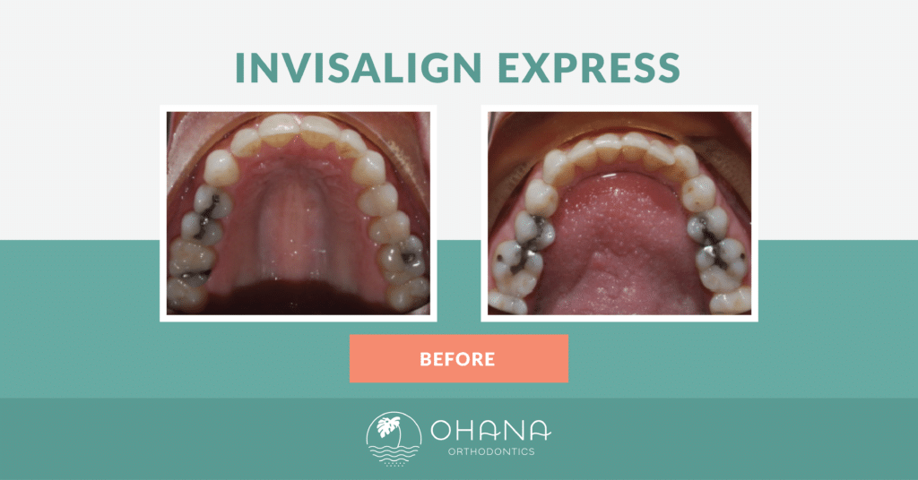 Before and After Photos Show Invisalign Helps Your Smile - Ohana ...