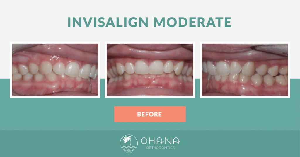 Before and After Photos Show Invisalign Helps Your Smile - Ohana ...