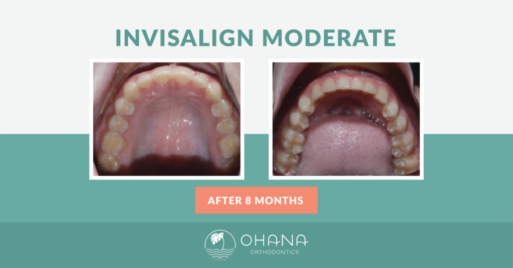 Before and After Photos Show Invisalign Helps Your Smile - Ohana ...