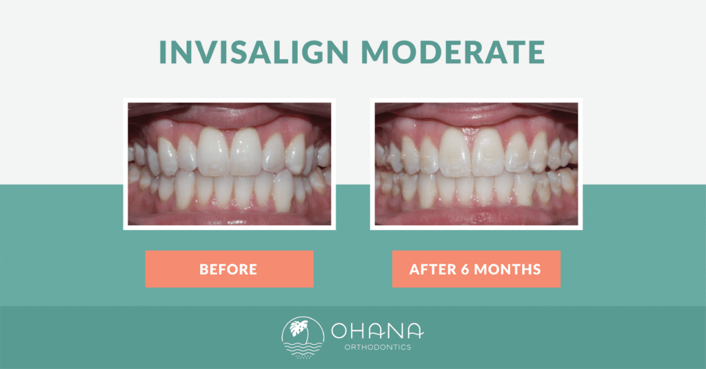 Before and After Photos Show Invisalign Helps Your Smile - Ohana ...