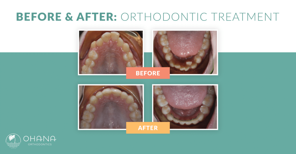 Braces Before and After: How Can They Help Your Smile? - Ohana ...